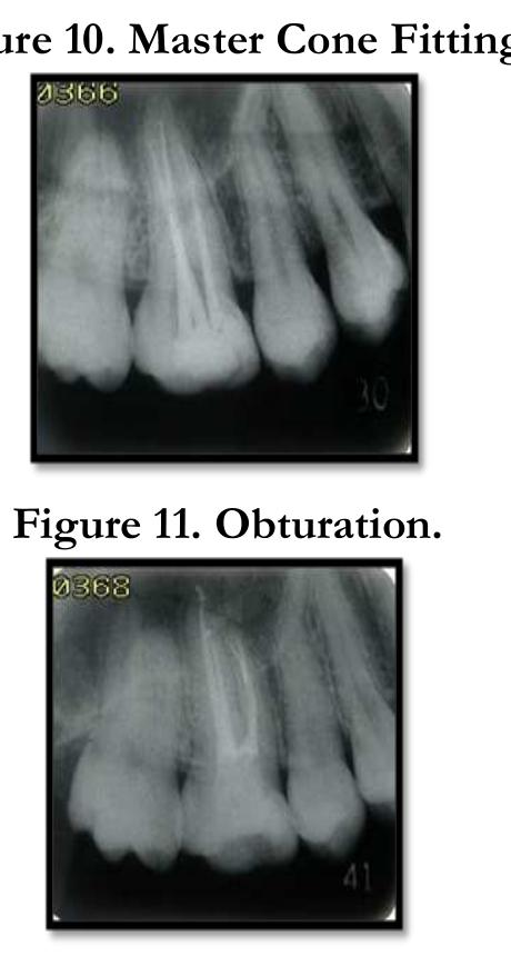 The tooth was then restored with composite resin onlay