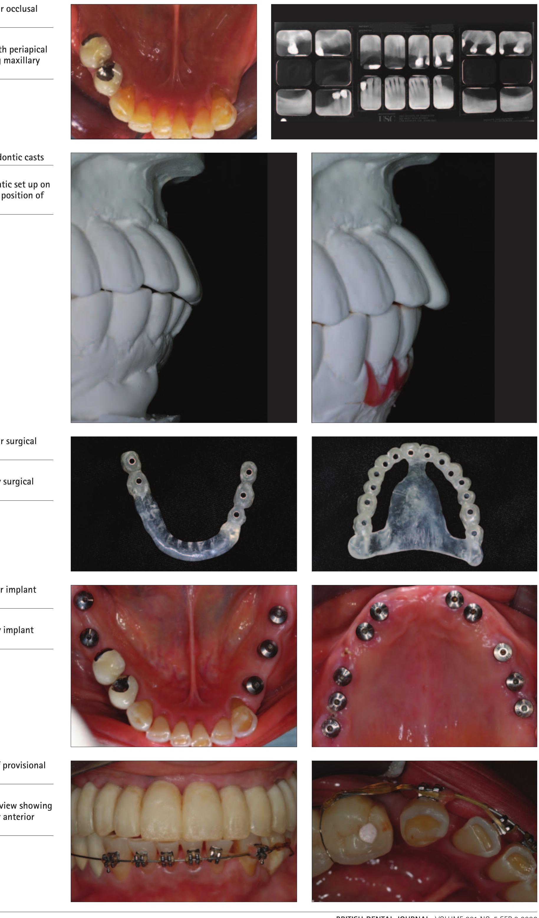 Figure 5 - Treatment planning of the edentulous maxilla