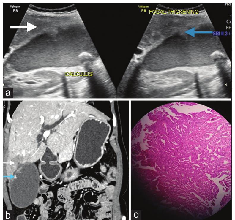 (a) transabdominal ultrasonography features in a 35-year-old