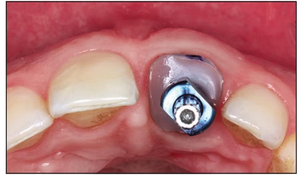 Occlusal view of the customized implant transfer coping.