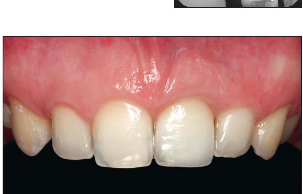 Facial view of the definitive restoration at the 6-month