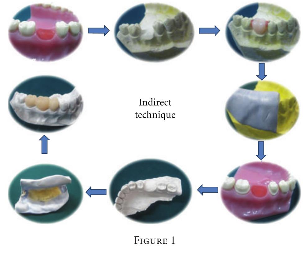 2.1. indirect provisional fixed partial denture. the