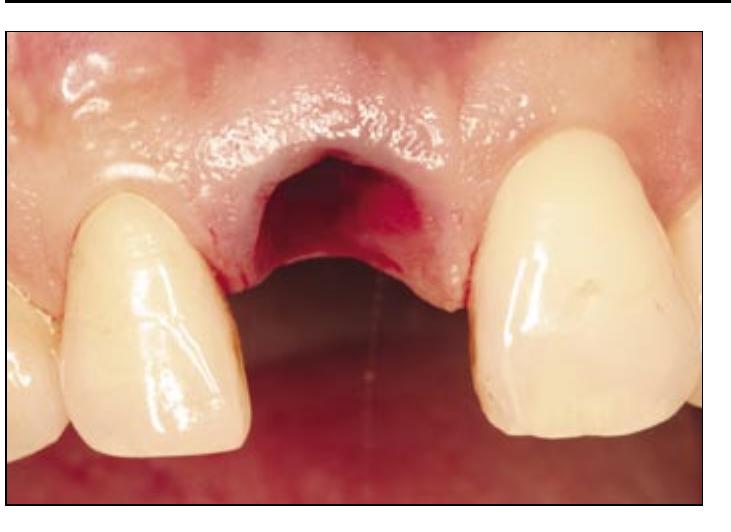 Figure 6 - Extraction Defect: Assessment, Classification and