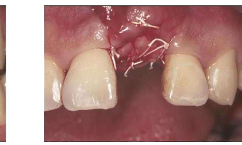 Figure 14 - Extraction Defect: Assessment, Classification