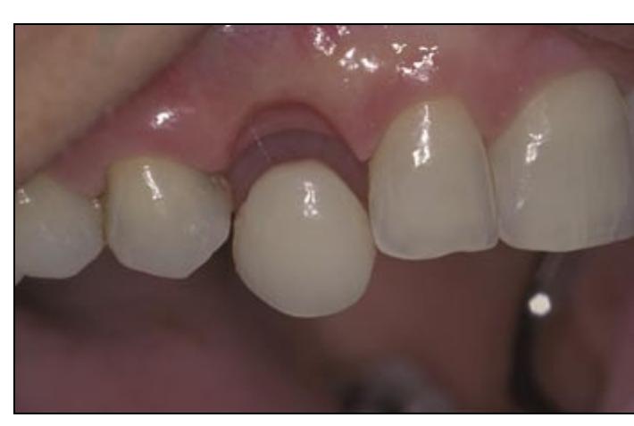 Figure 22 - Extraction Defect: Assessment, Classification