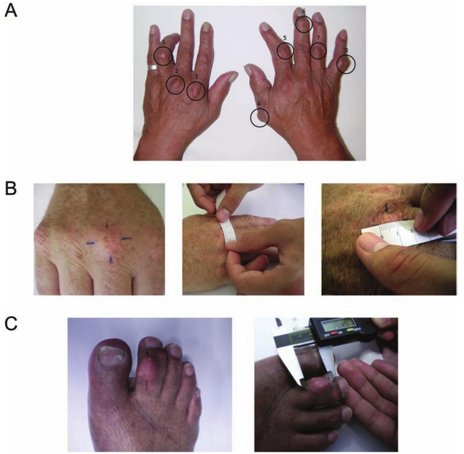 Physical assessment of subcutaneous tophi. a. counting the