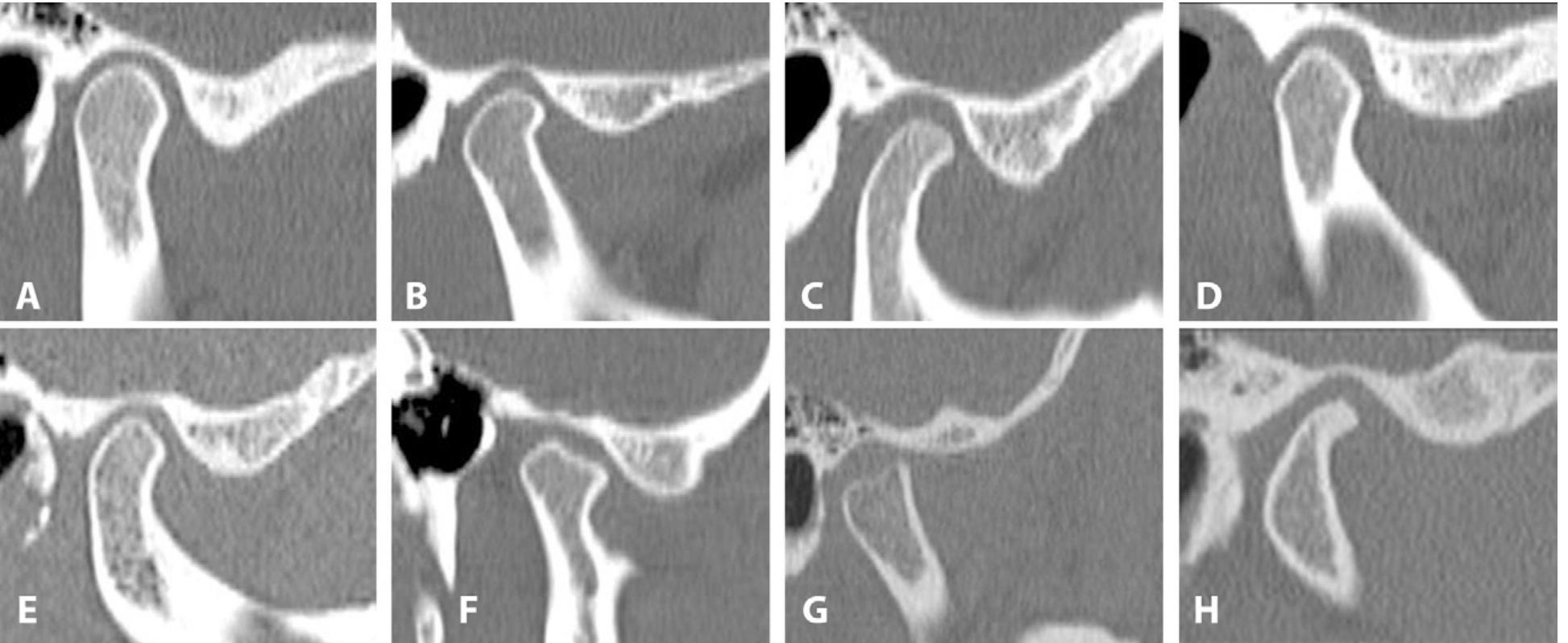 Sagittal computerized tomography views of condyles