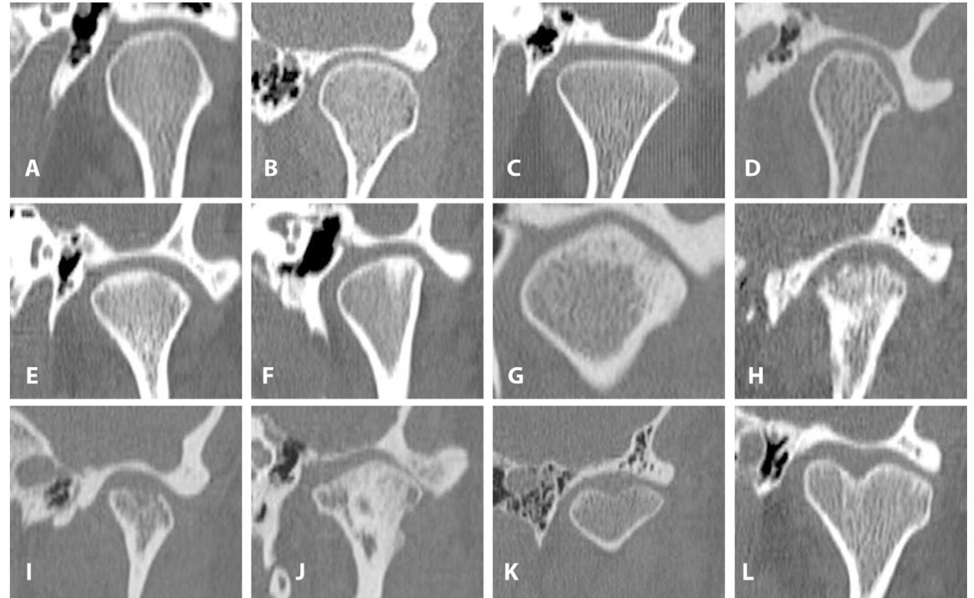 Axially corrected coronal computerized tomography views of
