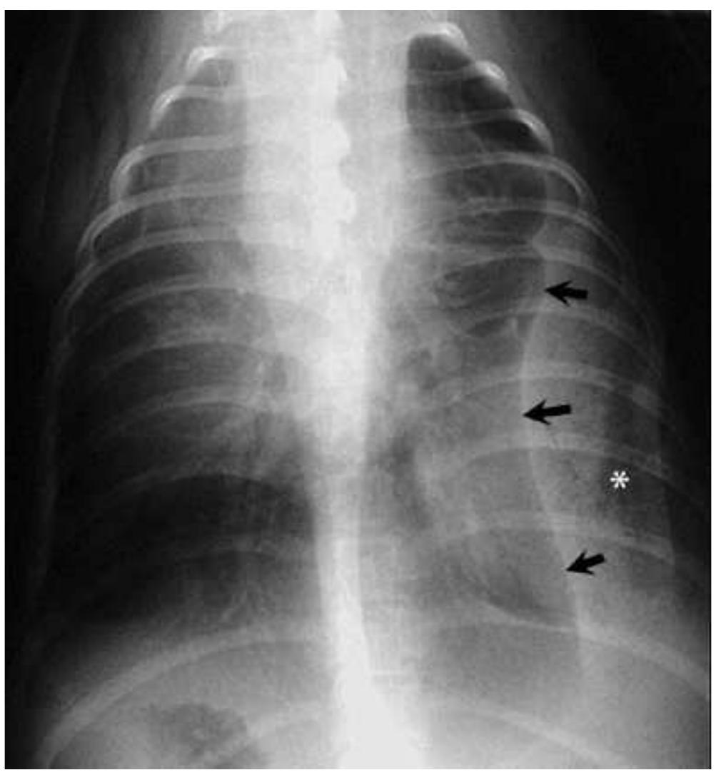 Fic. 8. ventrodorsal thoracic radiograph of a dog with left