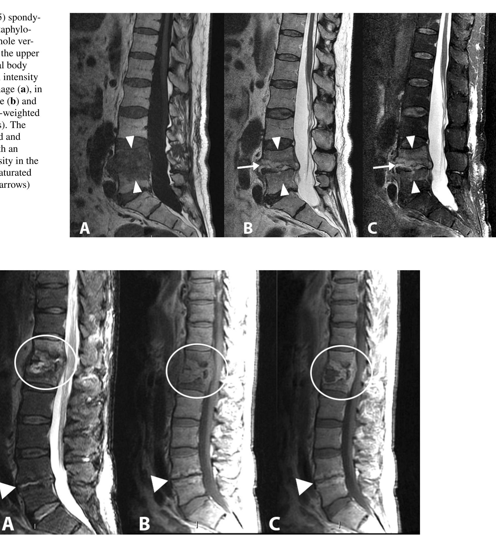 Spondylodiscitis caused by staphylococcus aureus. the d12-