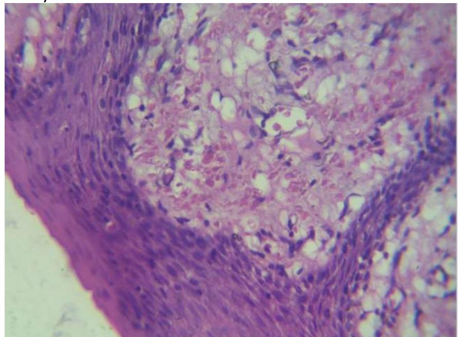 The size of pyogenic granuloma in the patients varied in