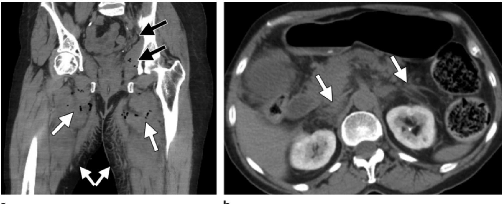 Necrotizing retroperitoneal fasciitis with indirect spread