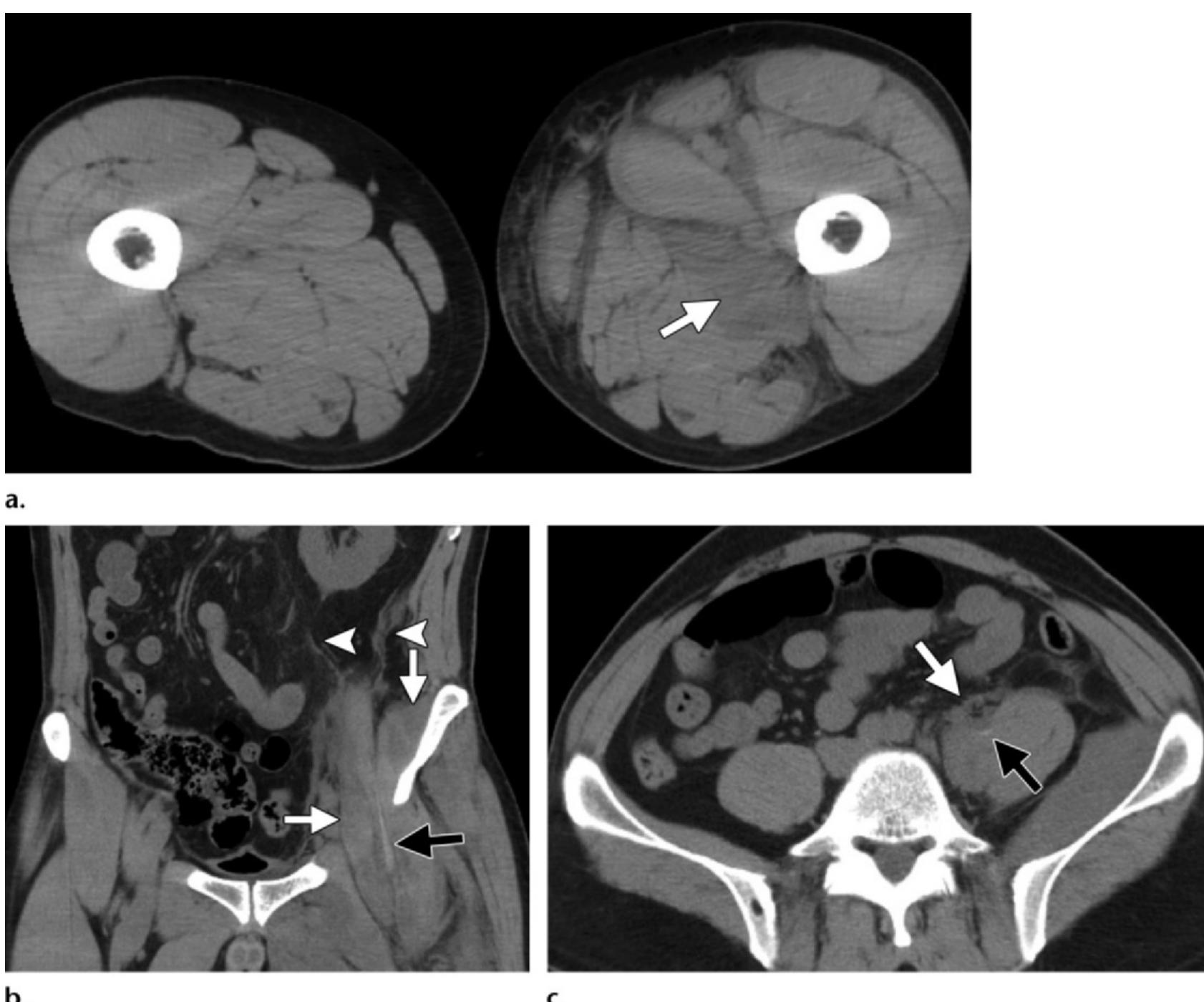 Necrotizing retroperitoneal fasciitis tracking indirectly
