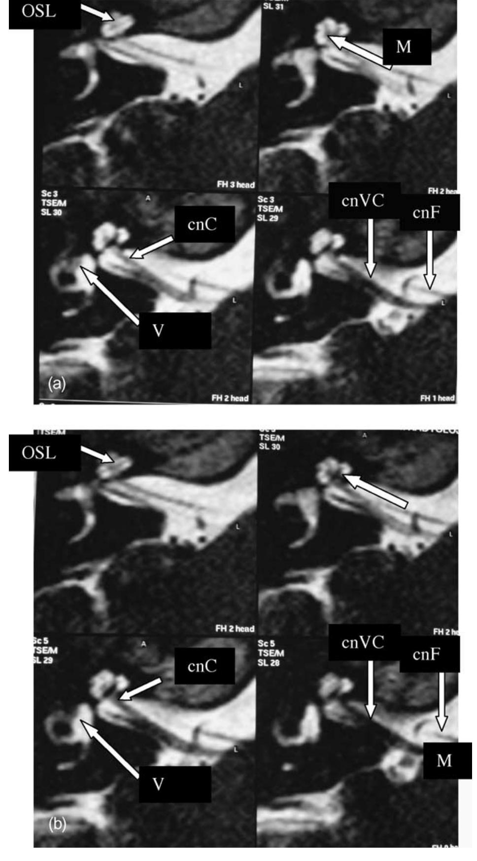 Four sequential images from axial t2-weighted 3d tse (a) and