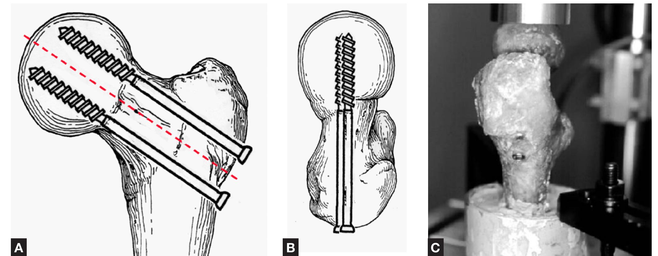 (a,b) diagrams of proximal femur with 2 screws in the