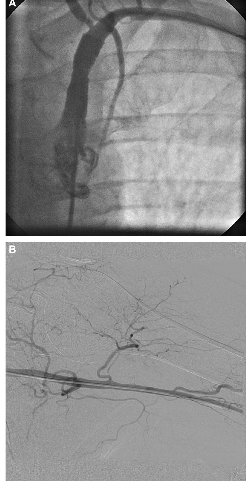 (a) left subclavian artery | day after recanalization and