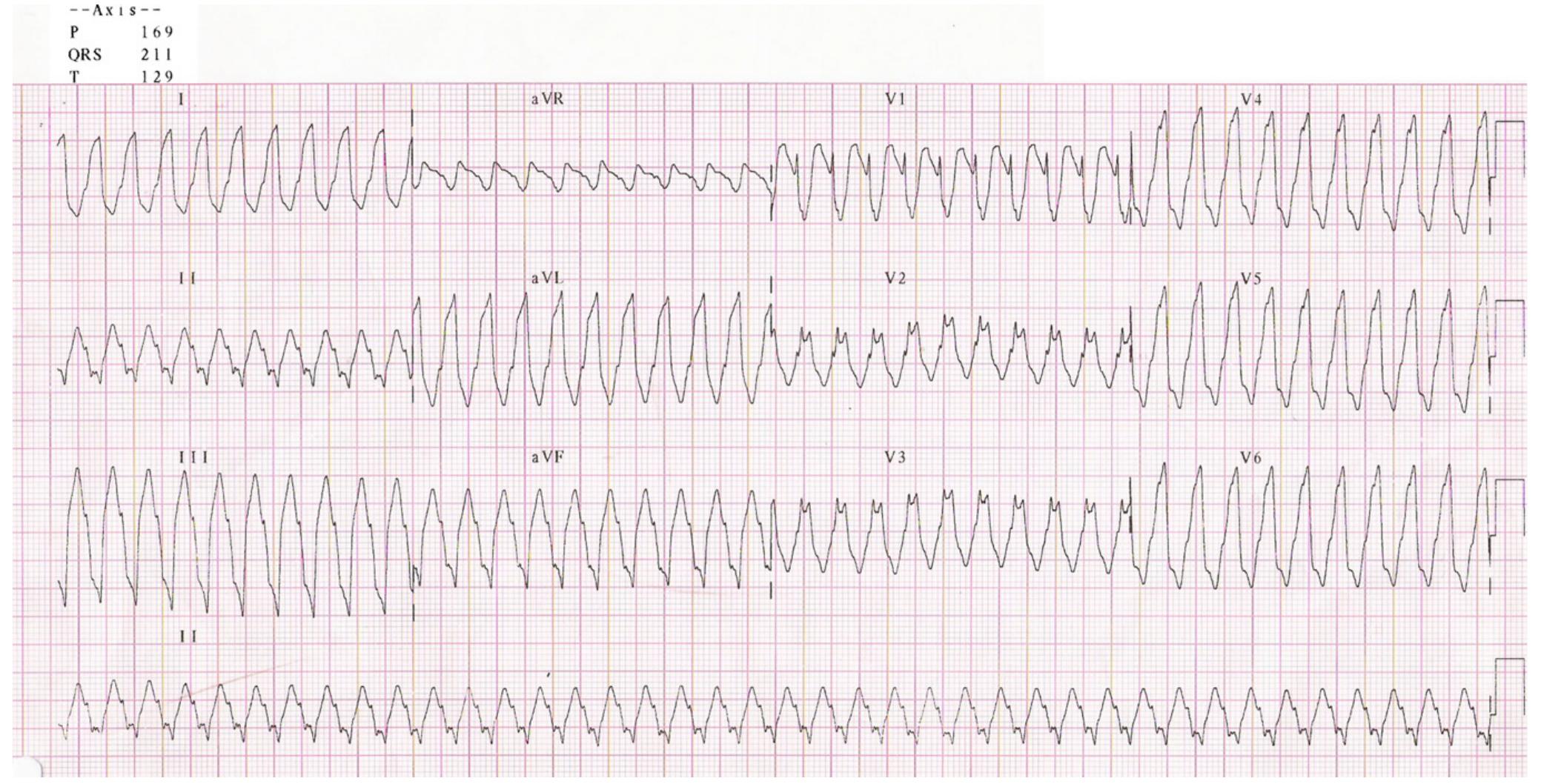 ecg showing wide qrs tachycardia at 250 beats/minute with