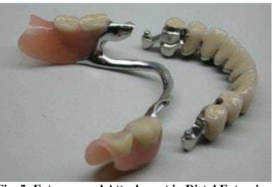 Figure 4 - from Precision attachments-An overview