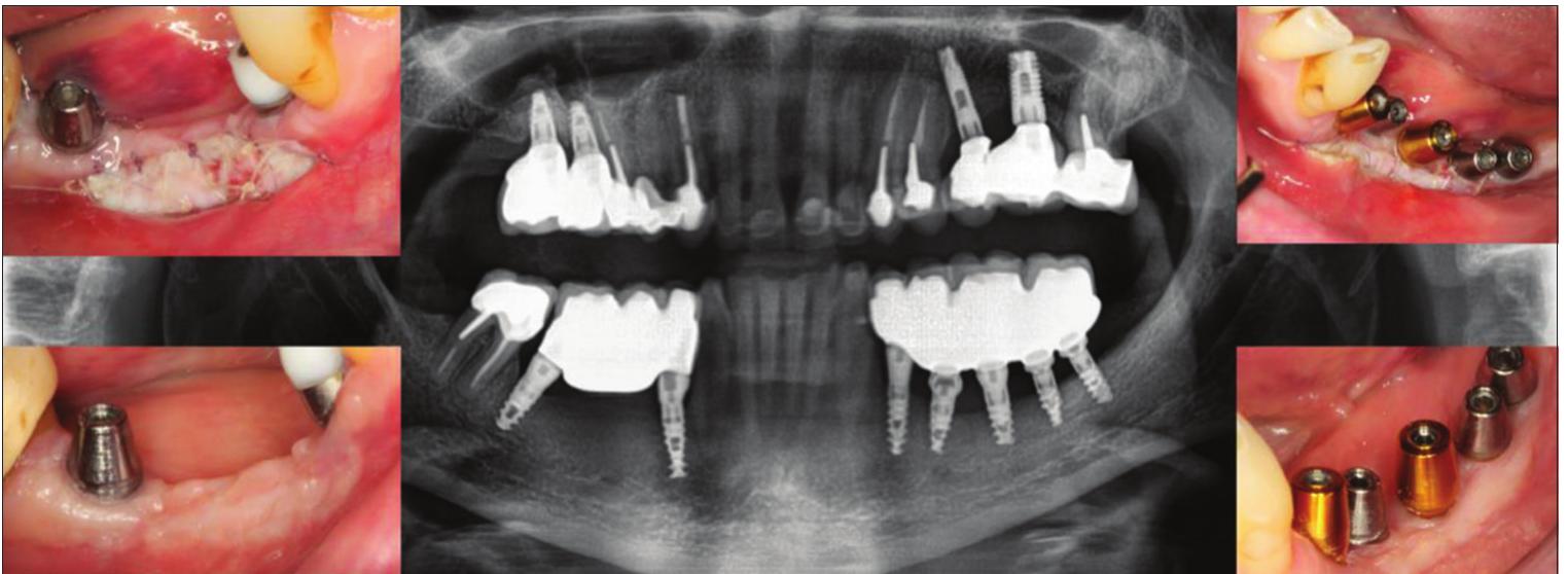 (PDF) Stage-two Surgery for Dental Implants: Overview and Relevance of ...