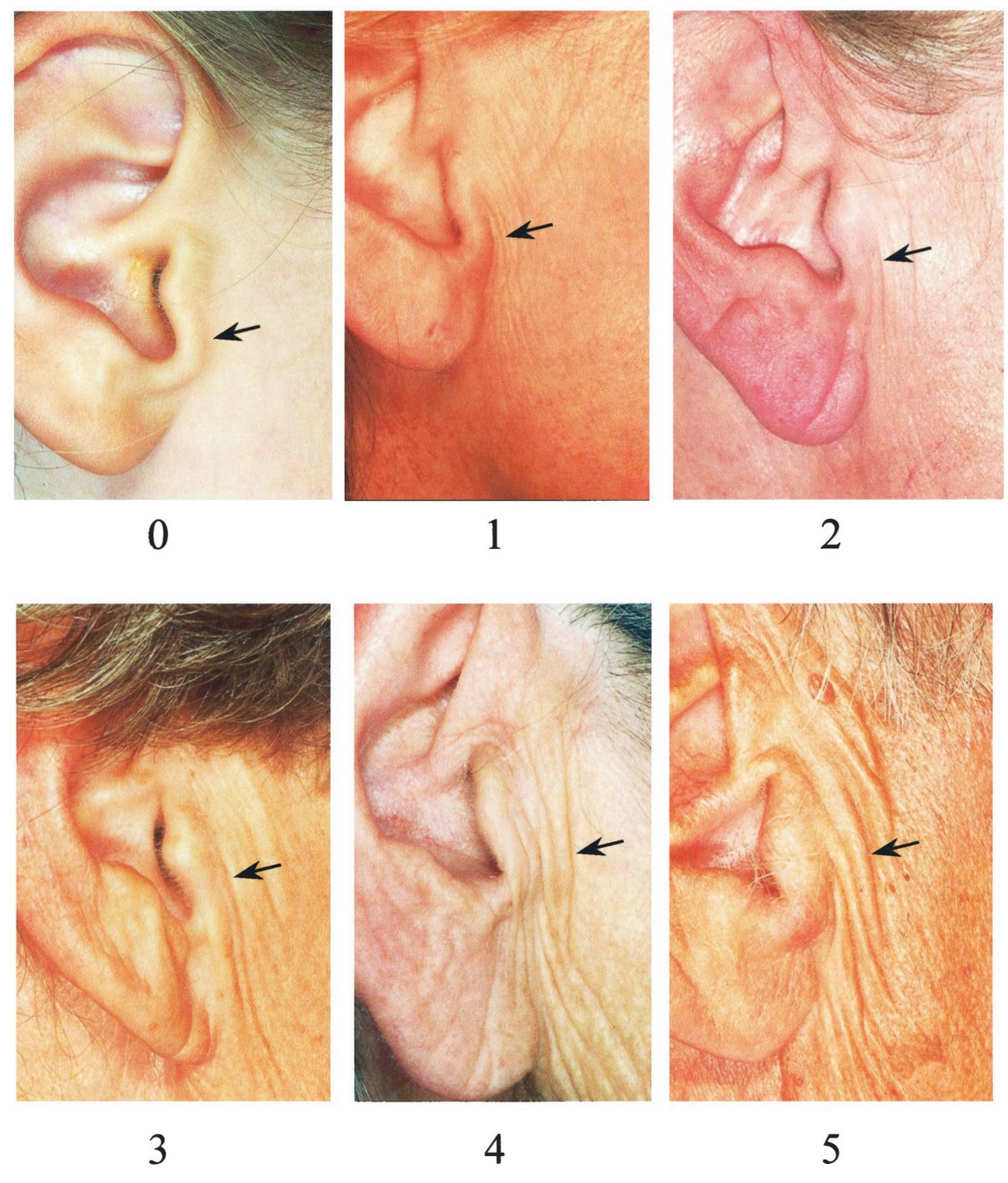 Fic. 6. wrinkle assessment scale of preauricular lines.