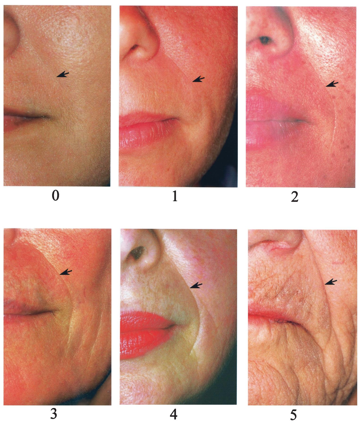 Fic. 8. wrinkle assessment scale of nasolabial folds.