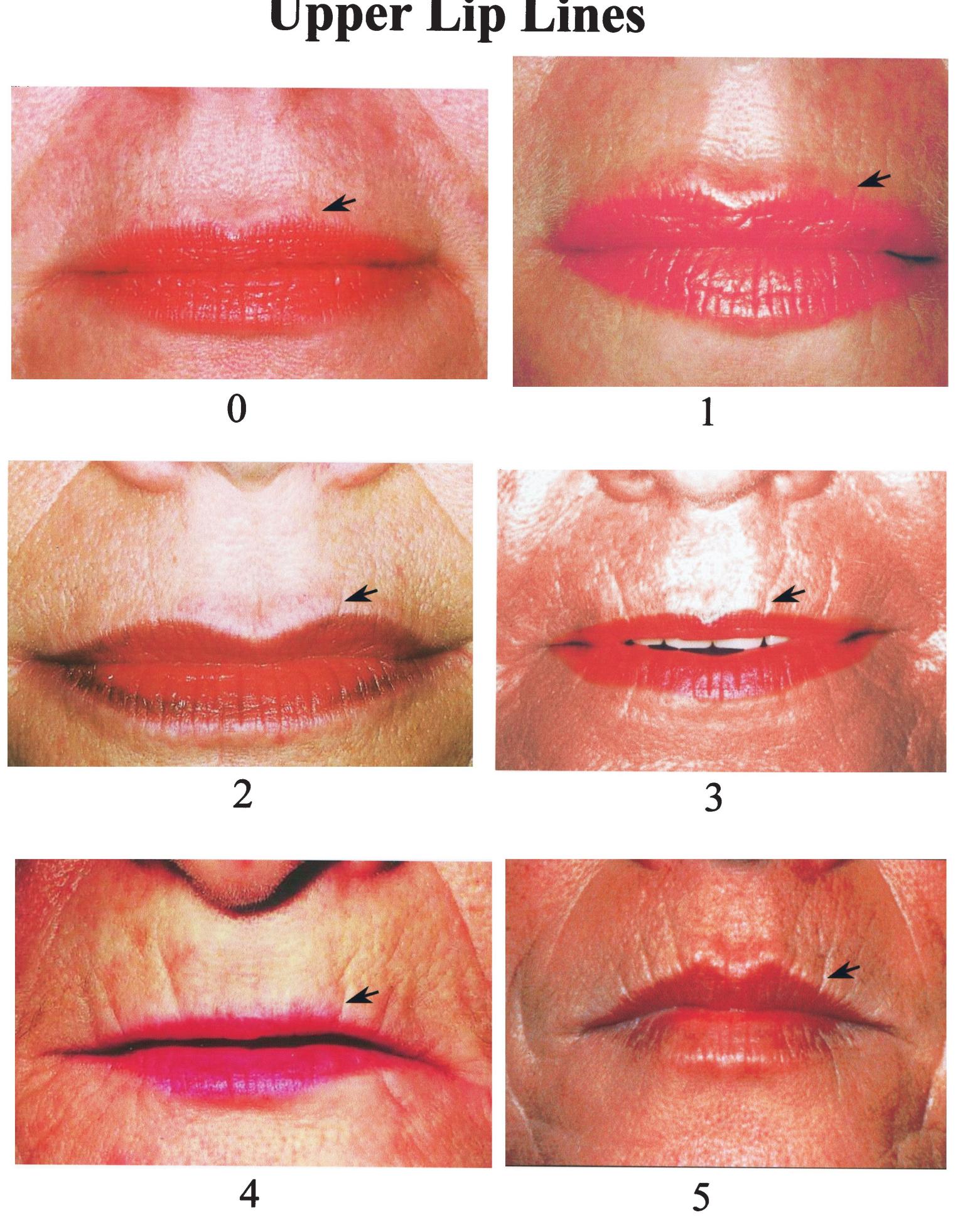 Fic. 9. wrinkle assessment scale of upper lip lines.
