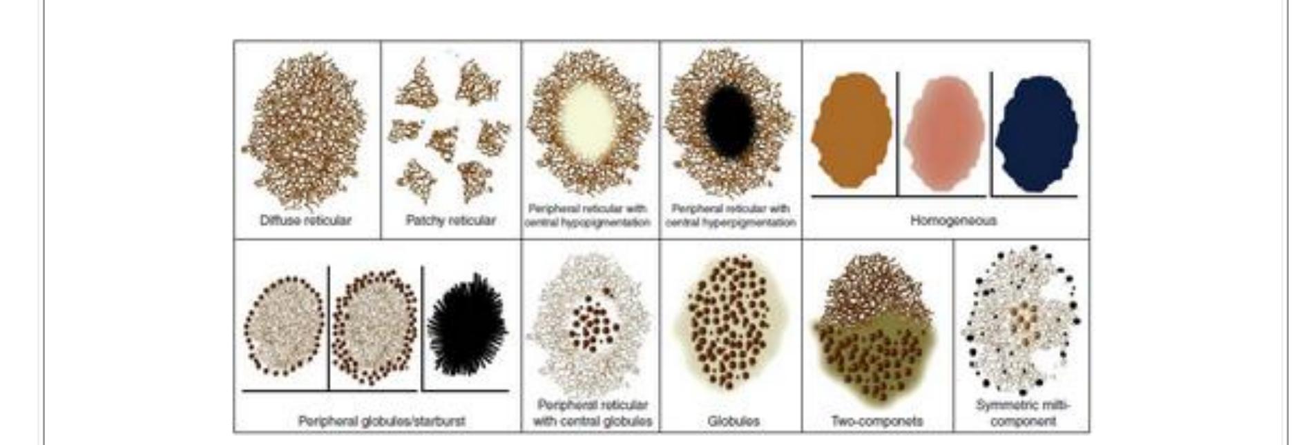 Diagram showing dermoscopy benign nevus patterns [4