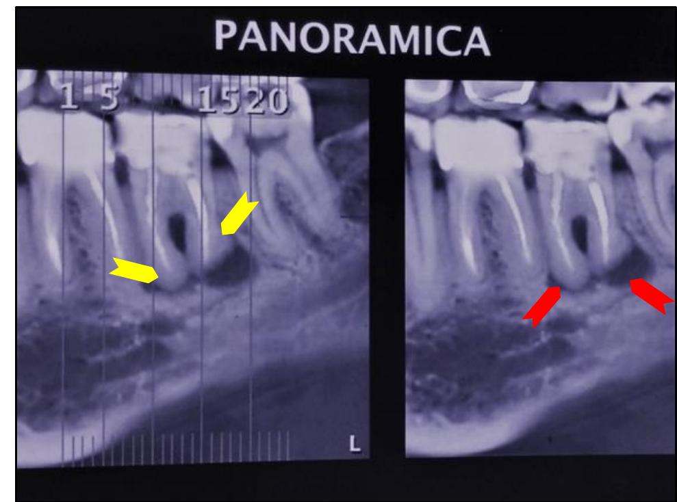 (2). panoramic reconstruction showing periapical lesions