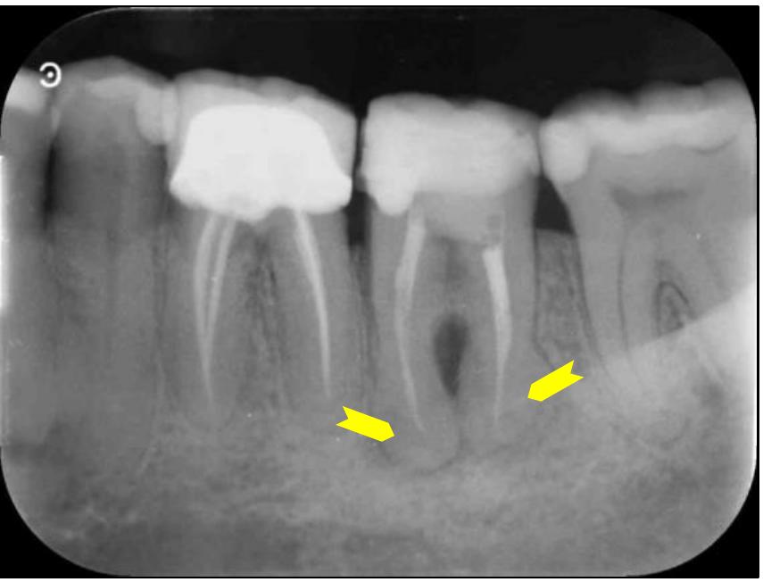 The intraoral peri-apical radiograph showed a previous root