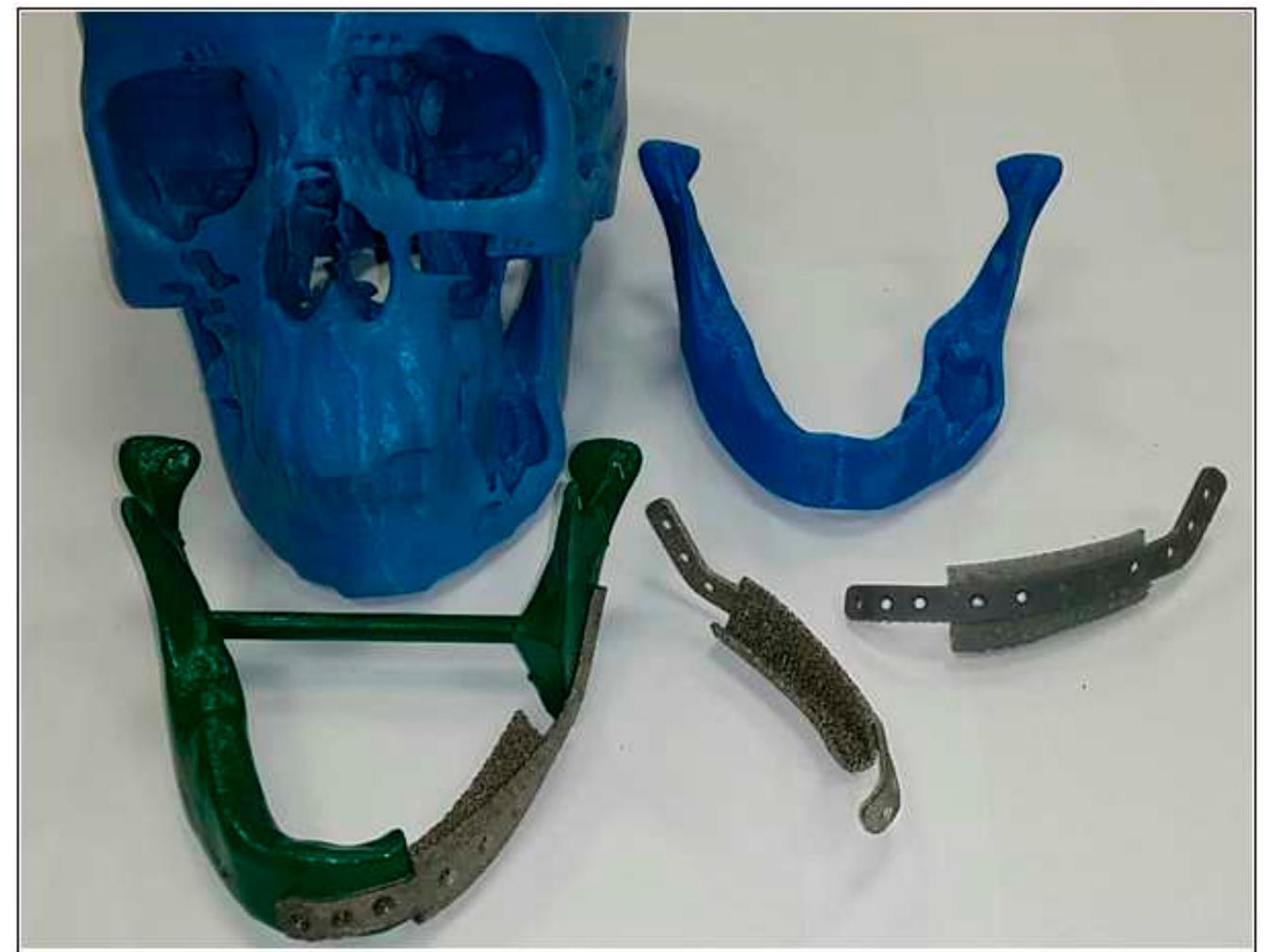 Ebm and polymer fabricated mandibular framework models with