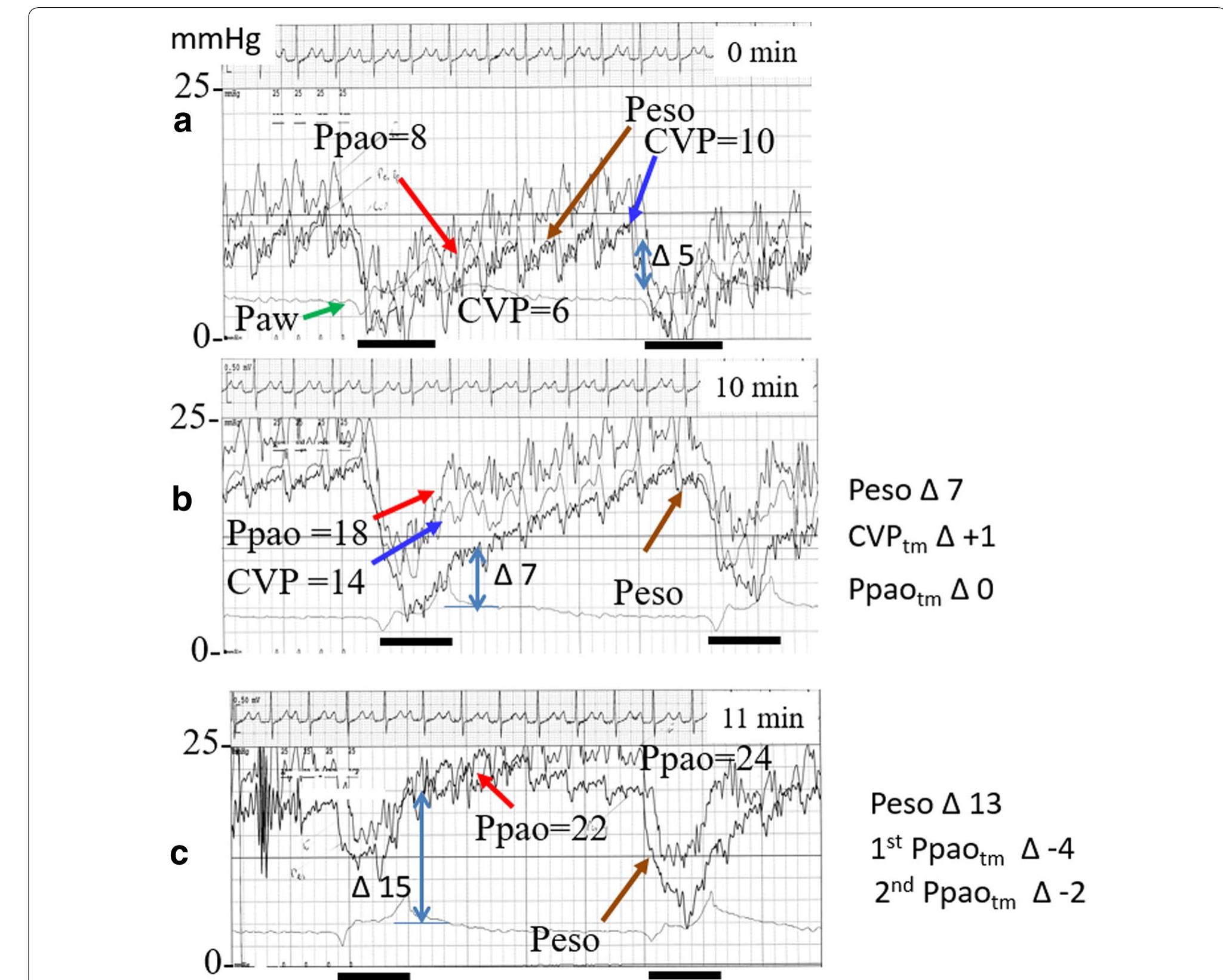 Value of esophageal pressure (peso)-derived transmural