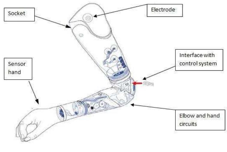 Myoelectric prosthetic arm [2] b. externally myoelectric
