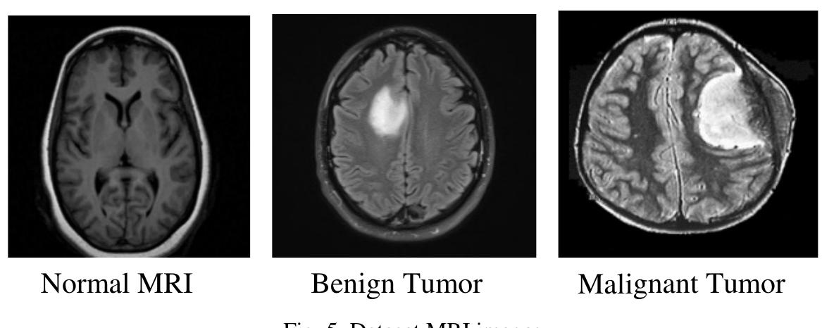 Shown the mri images of the normal mri, benign and malignant