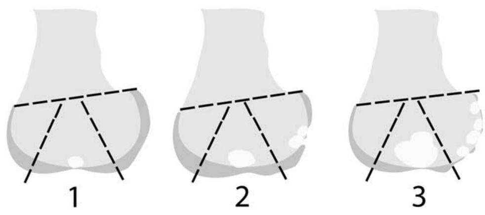 Subarticular cyst score. subarticular cyst score is based on