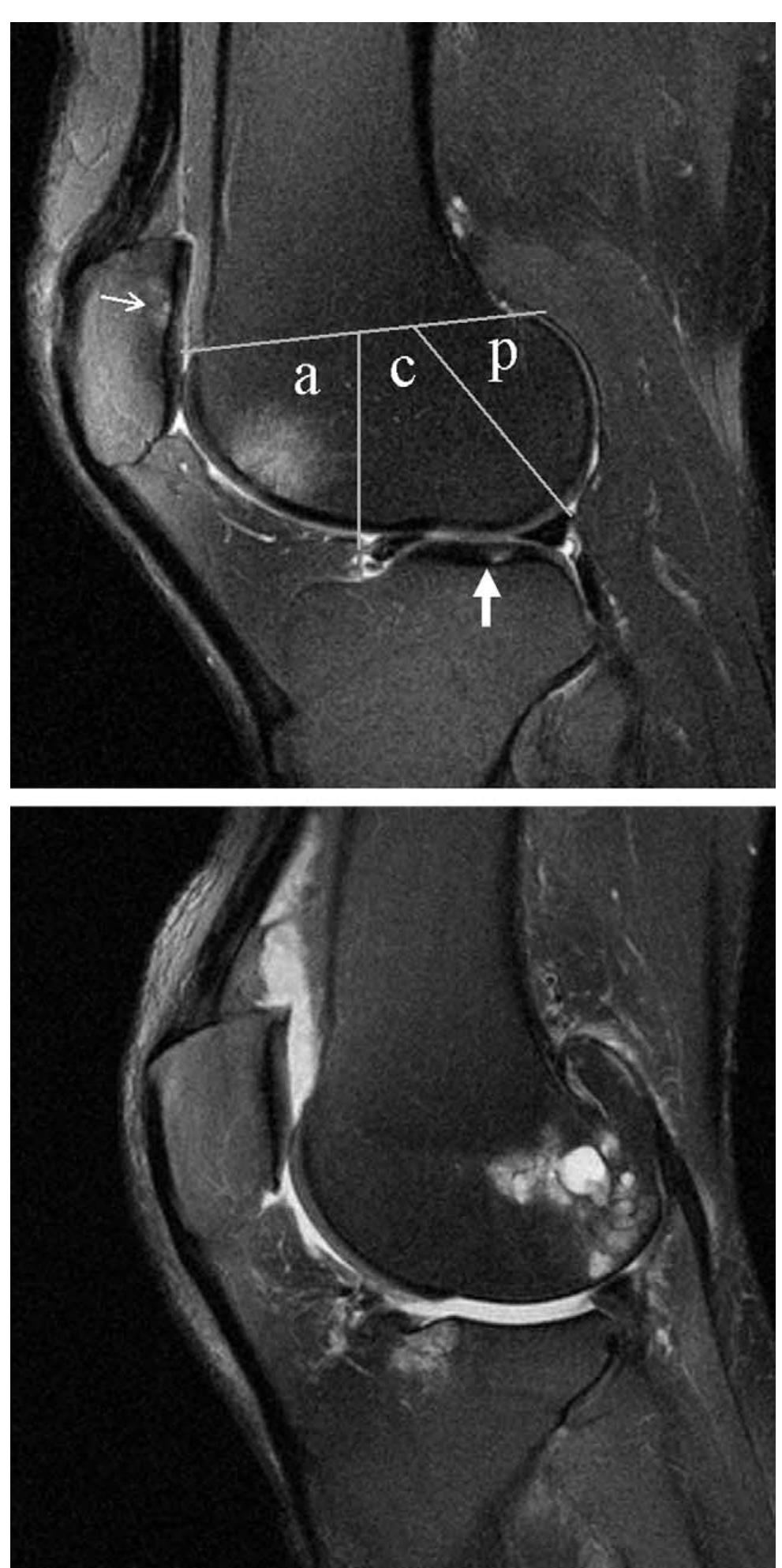 Sagittal t2-weighted fse. a. focal grade 1 cartilage signal