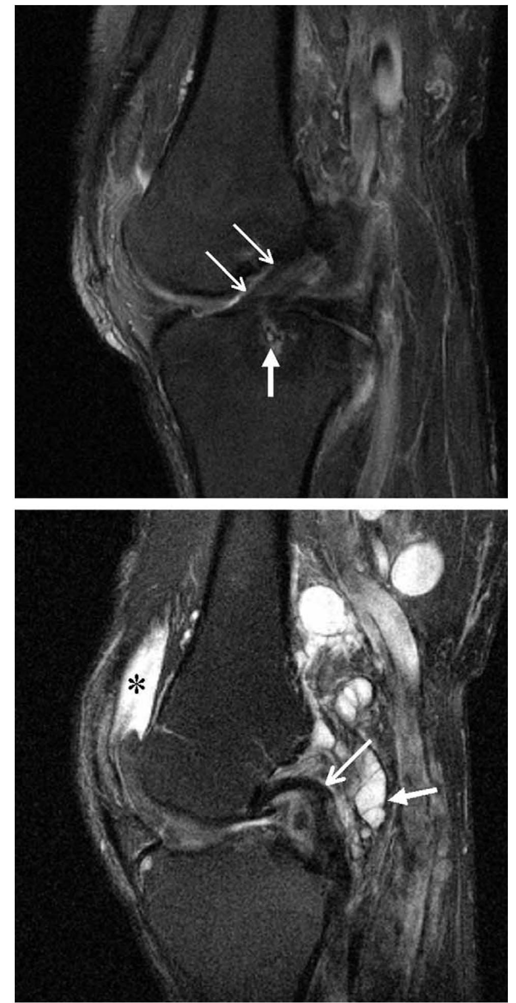 Imaging the acl. a. midsagittal fat-suppressed t2- weighted