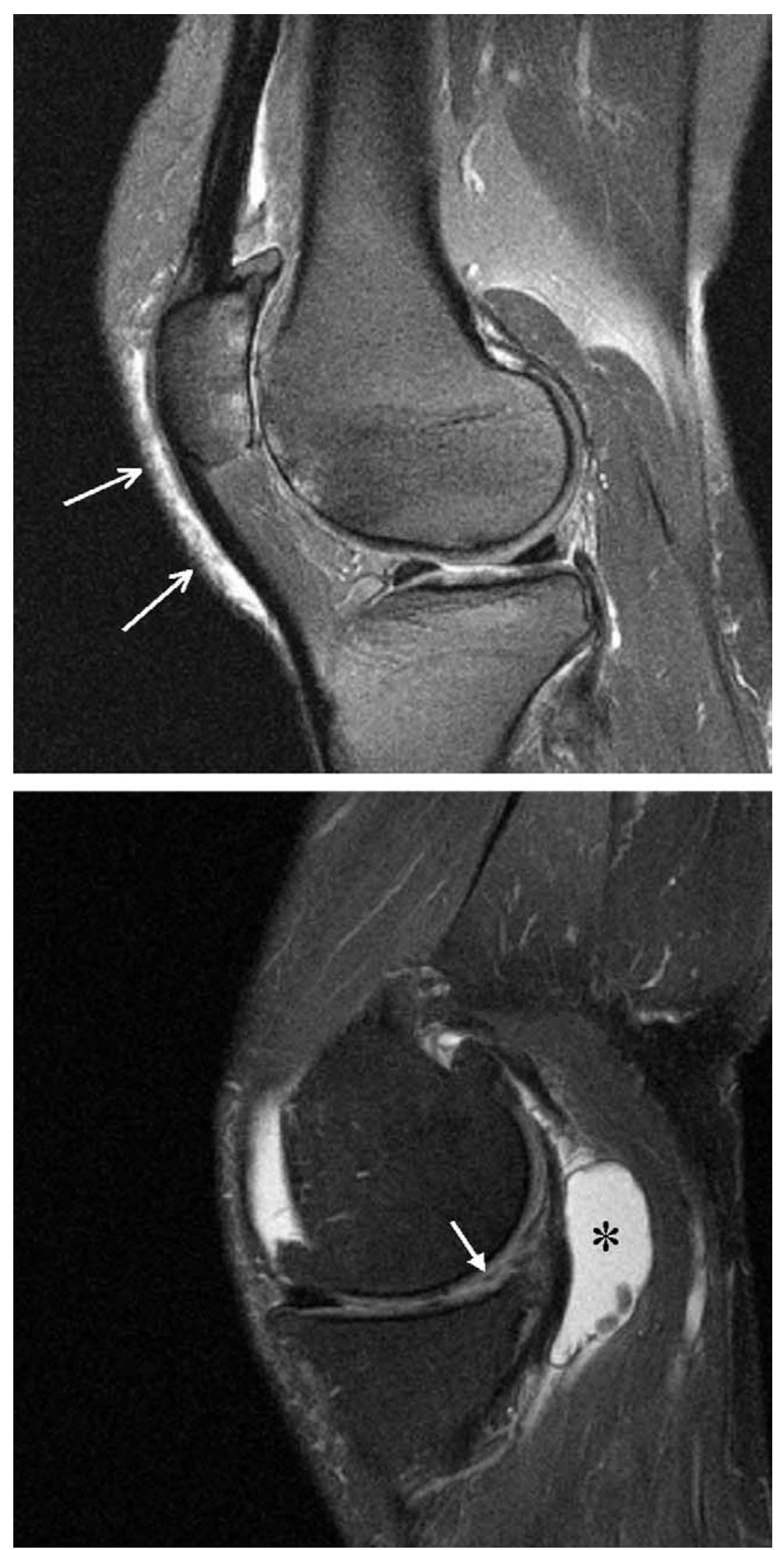 Periarticular bursitis and cysts. a. fluid signal over the