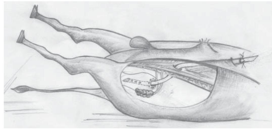 Artery forceps passed through stab incision in skin and