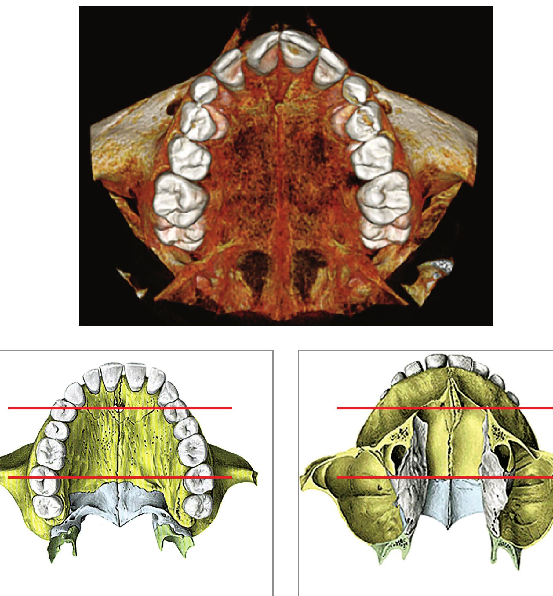 -midpalatal suture and its three segments (anterior, middle