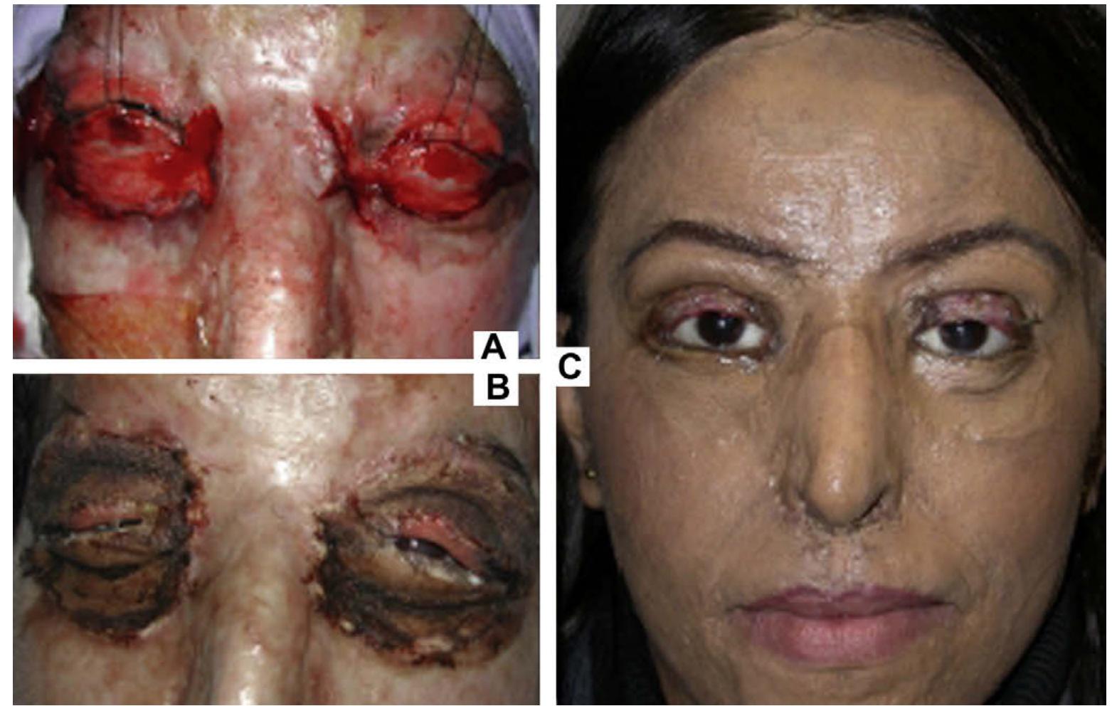 A: lower eyelid release of burn contracture