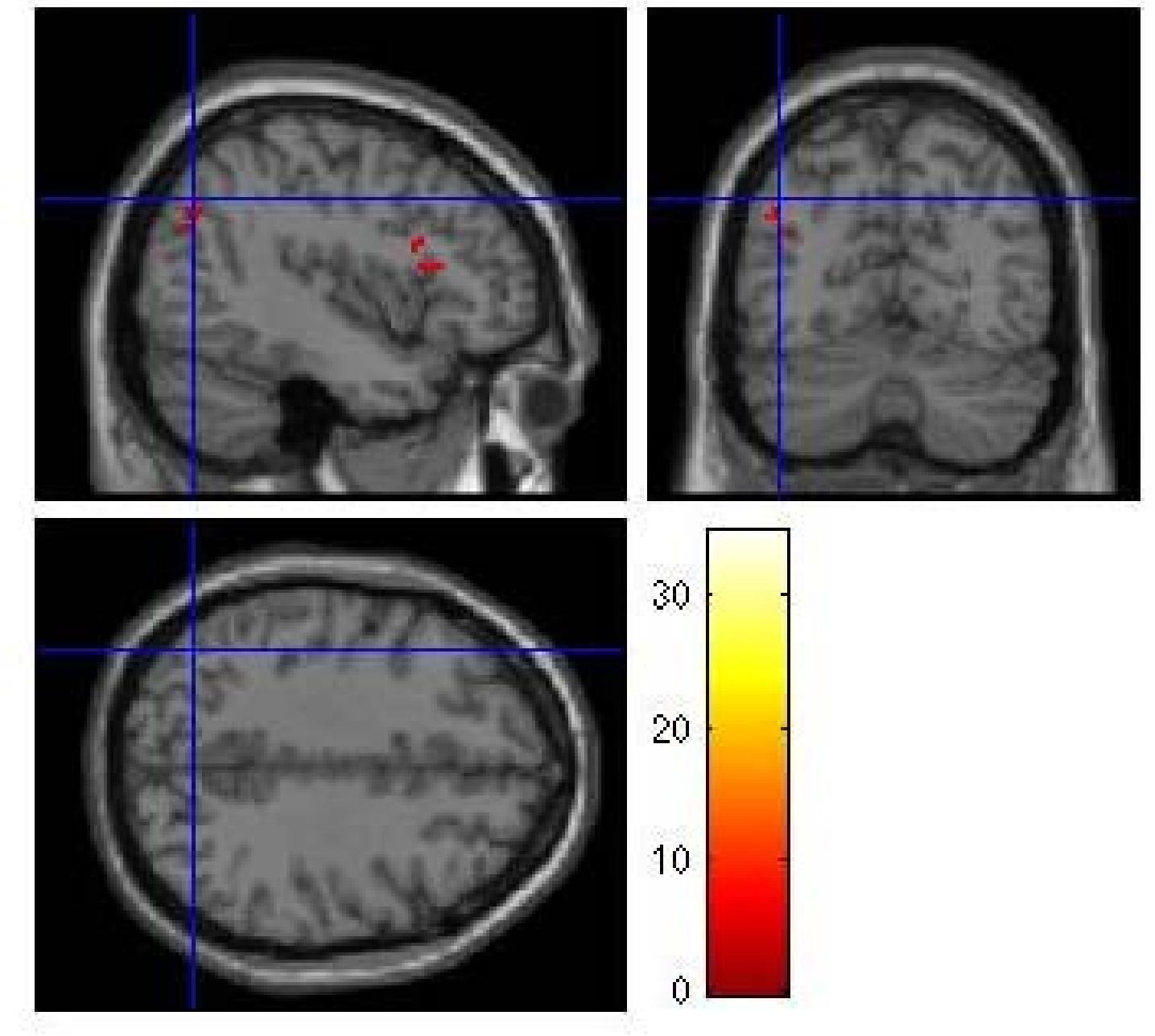 Activation of the left inferior parietal lobule (4)