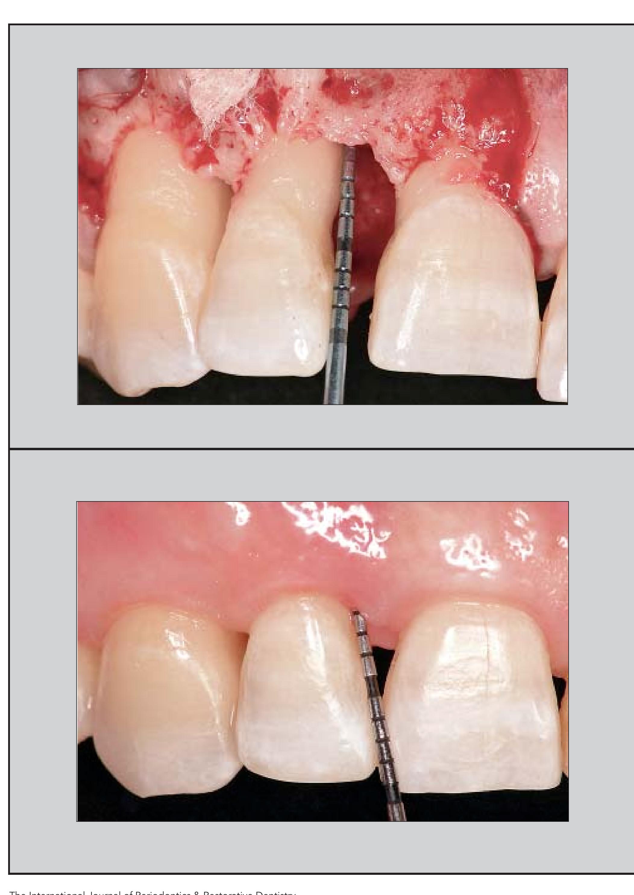 Figure 1 - Orthodontic treatment of periodontally involved