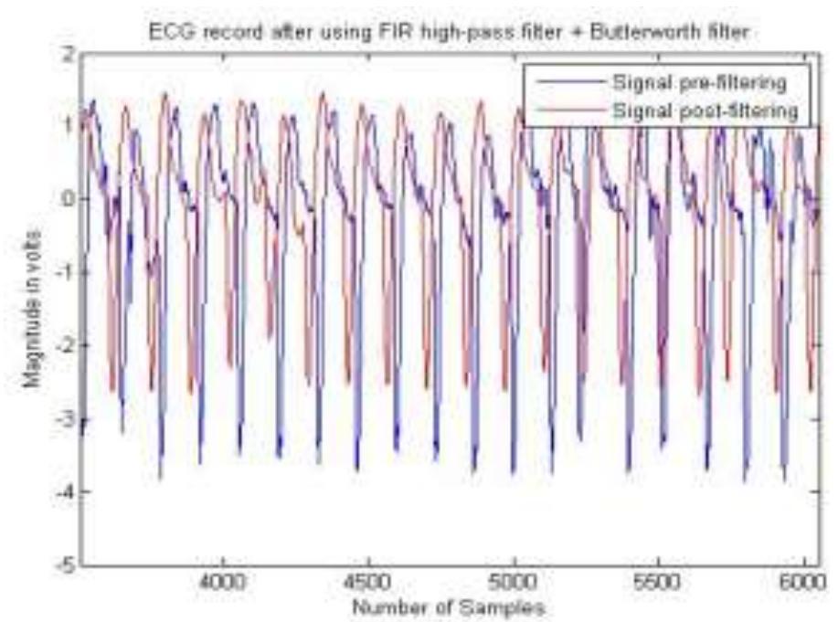 Ecg signal of third degree av block filtered with