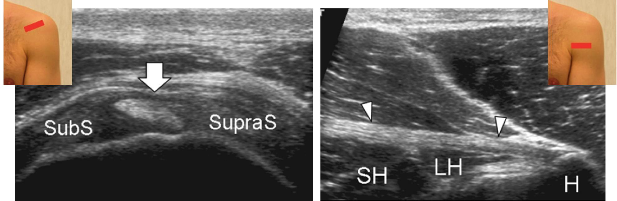 Legend subs subscapularis tendon; supras supraspinatus