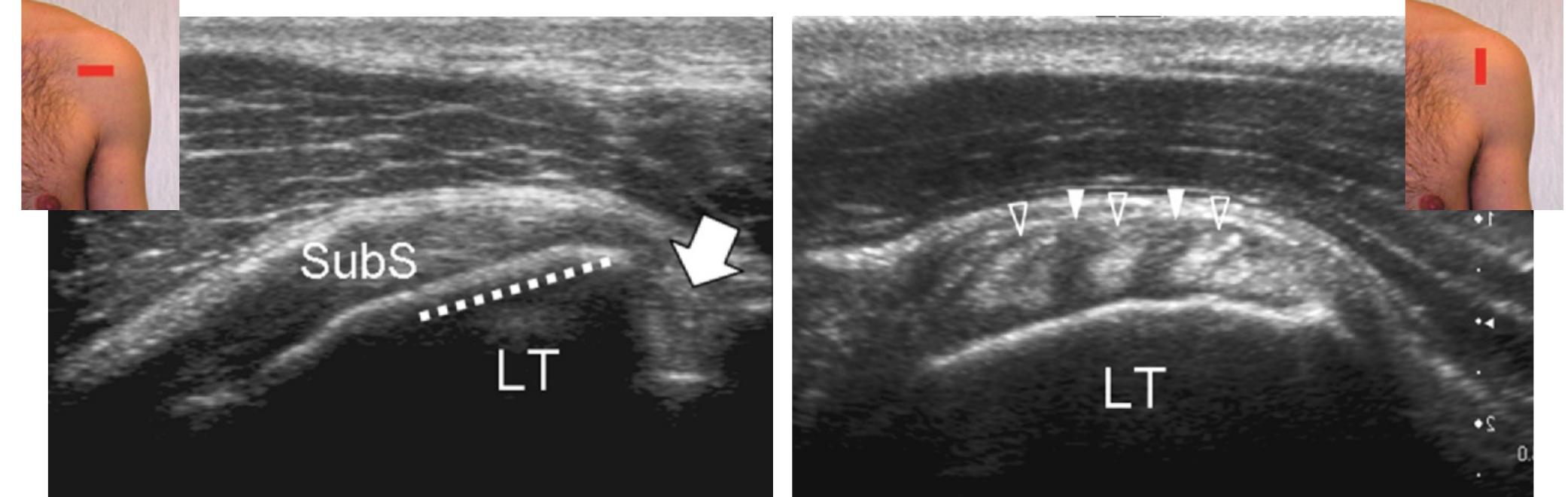 Legend arrow long head of the biceps tendon; dashed line