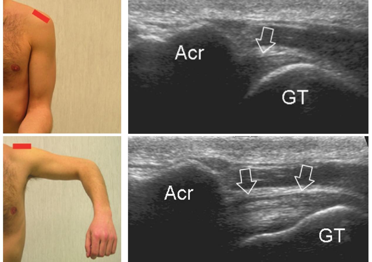 Dynamic assessment of subacromial (antero-superior)