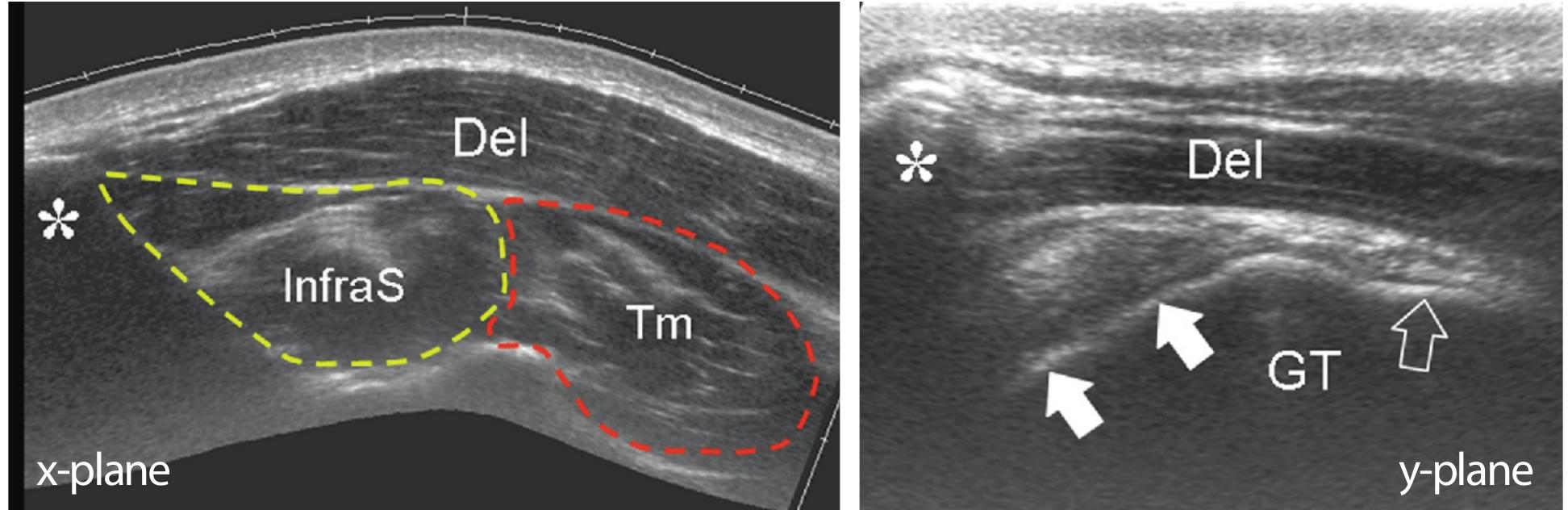 B asterisk spine of the scapula; dashed lines boundaries of