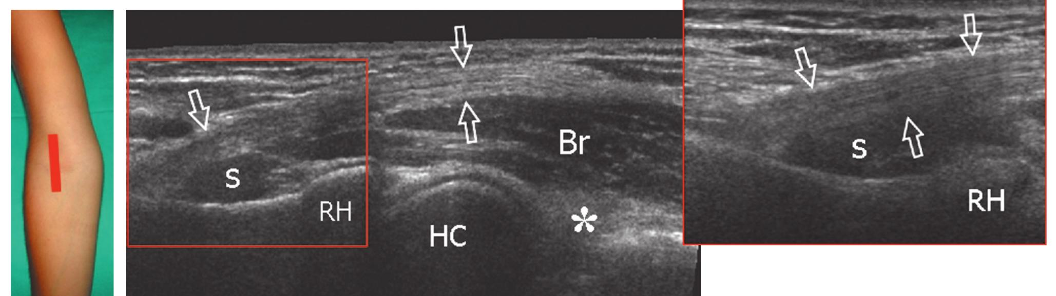 Legend arrows distal biceps tendon; asterisk coronoid fossa