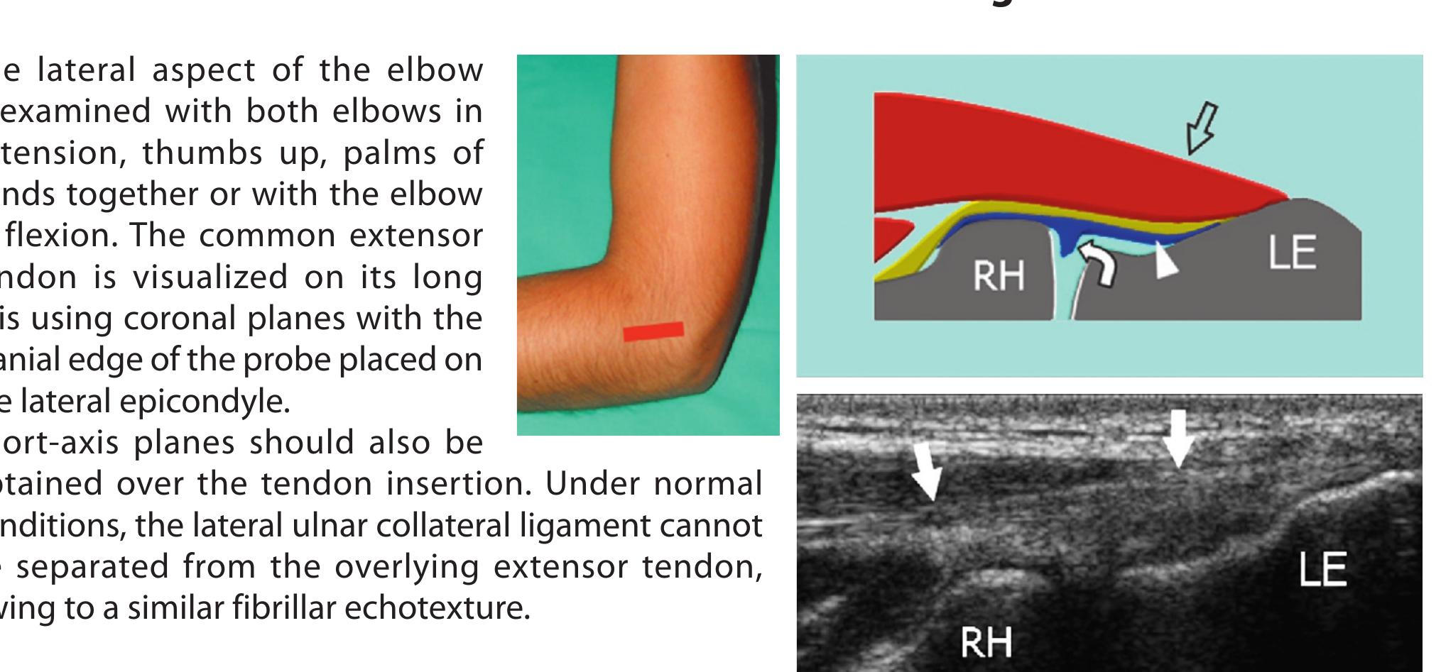 Legend arrowhead lateral ulnar collateral ligament; curved