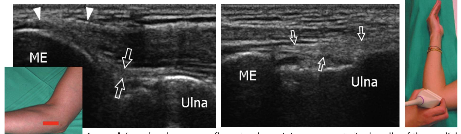 For examination of the medial elbow, the patient is asked to